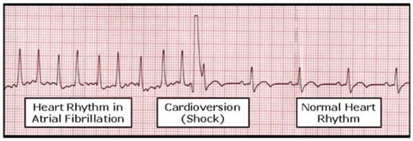 Electrical Cardioversion – Heart.ly – Midtown Medical Specialists blog